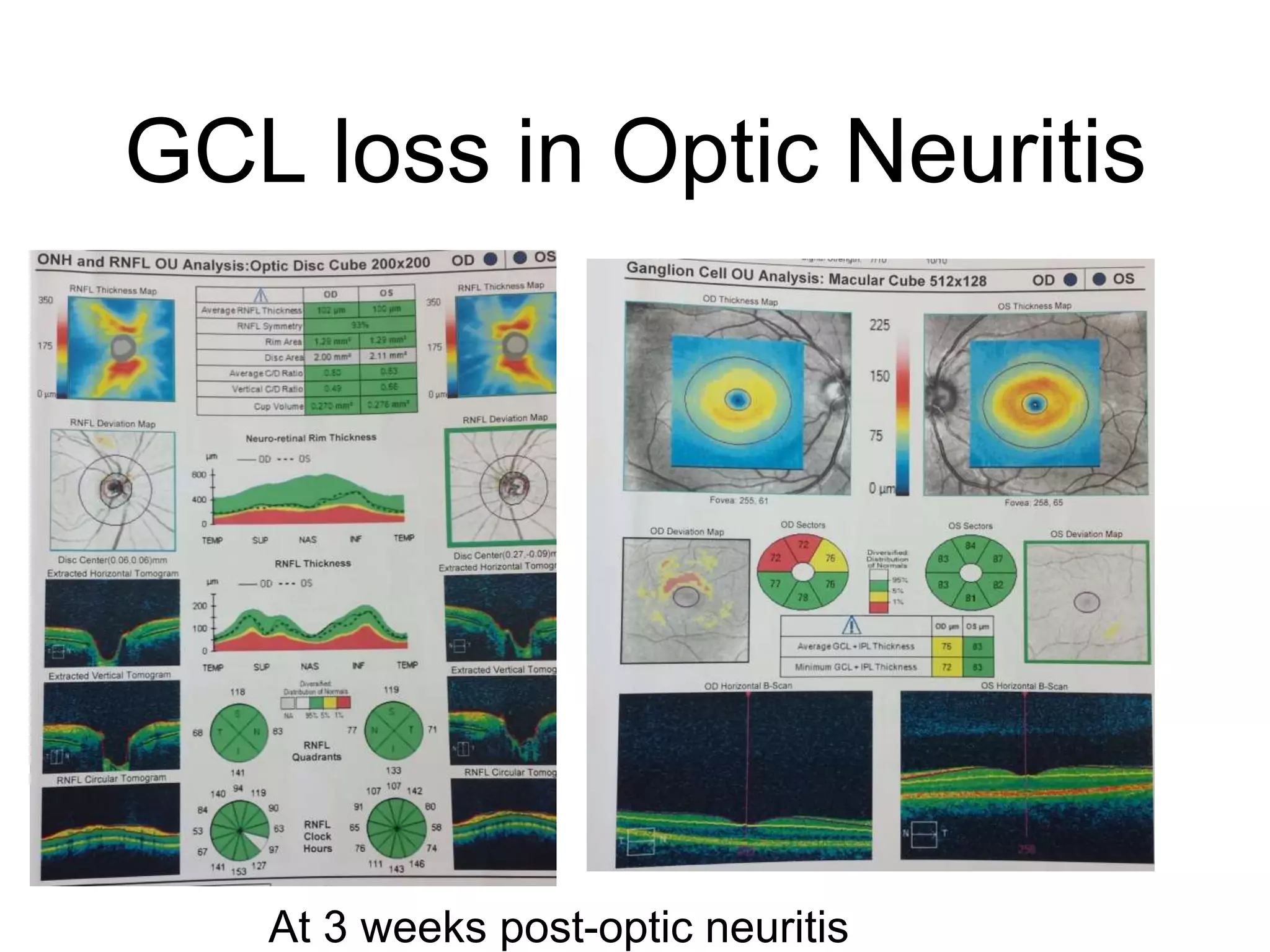 Optic Neuritis and OCT in Multiple Sclerosis | PPTX