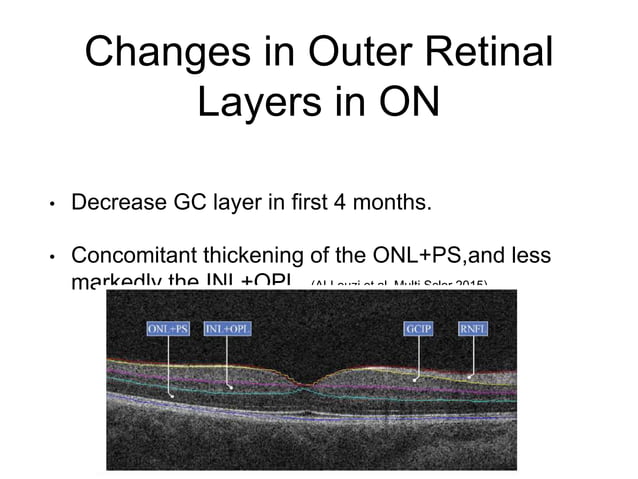Optic Neuritis and OCT in Multiple Sclerosis | PPTX