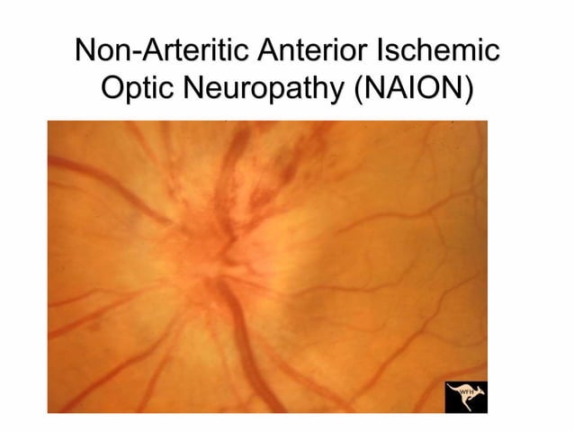 Optic Neuritis and OCT in Multiple Sclerosis | PPTX