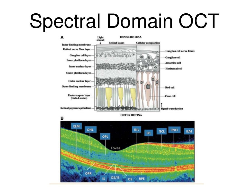 Optic Neuritis and OCT in Multiple Sclerosis
