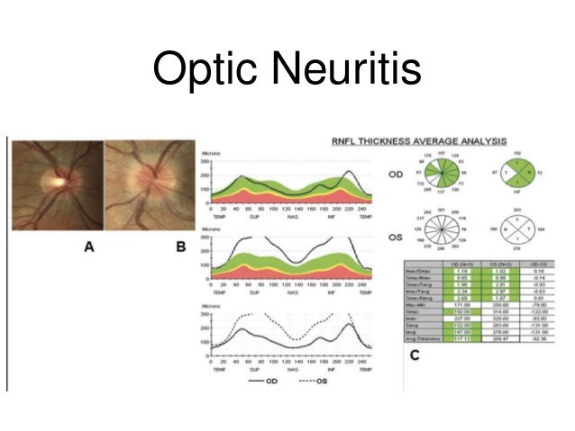 Optic Neuritis and OCT in Multiple Sclerosis