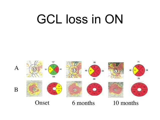 Optic Neuritis and OCT in Multiple Sclerosis | PPTX | Eye and Vision Conditions | Diseases and ...