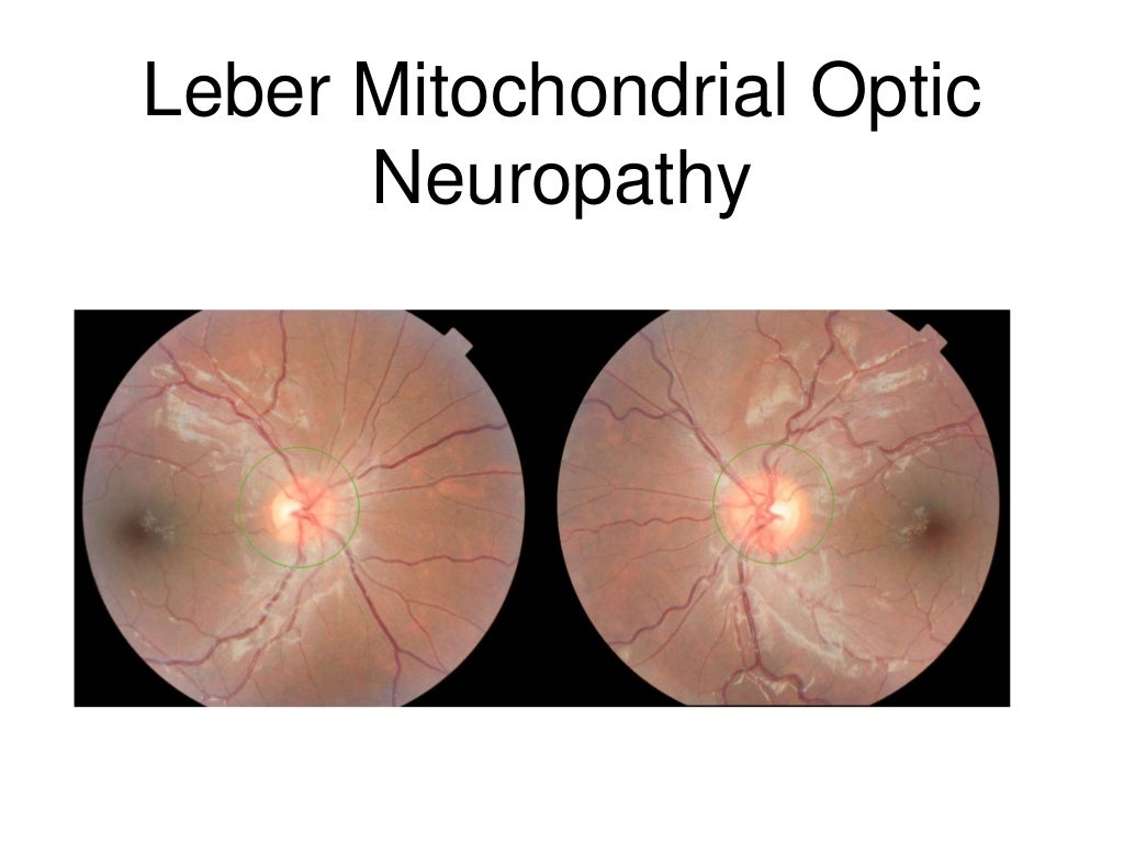 Optic Neuritis And Oct In Multiple Sclerosis