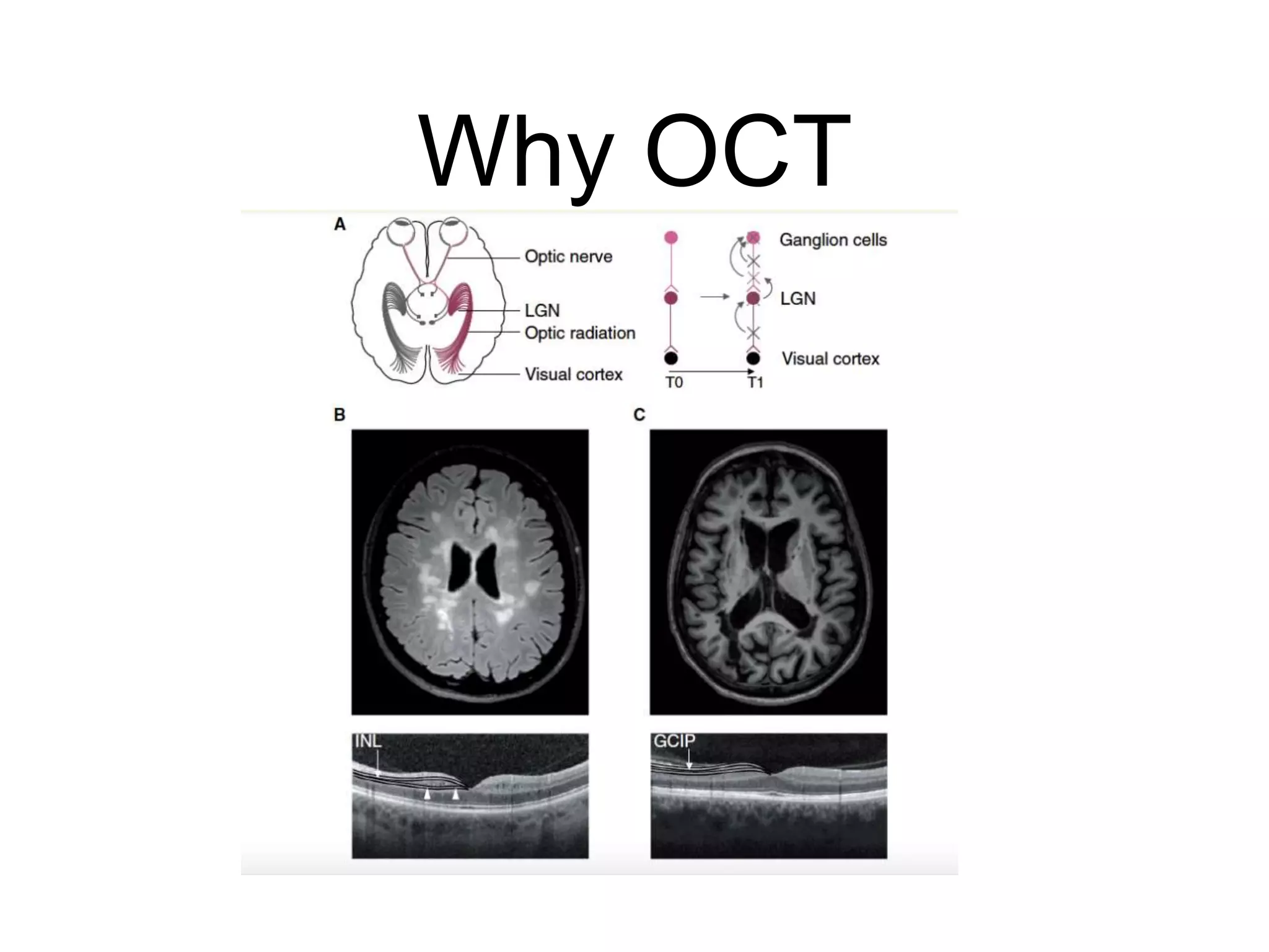 Update on Optic Neuritis and the role of OCT In Multiple Sclerosis | PPTX