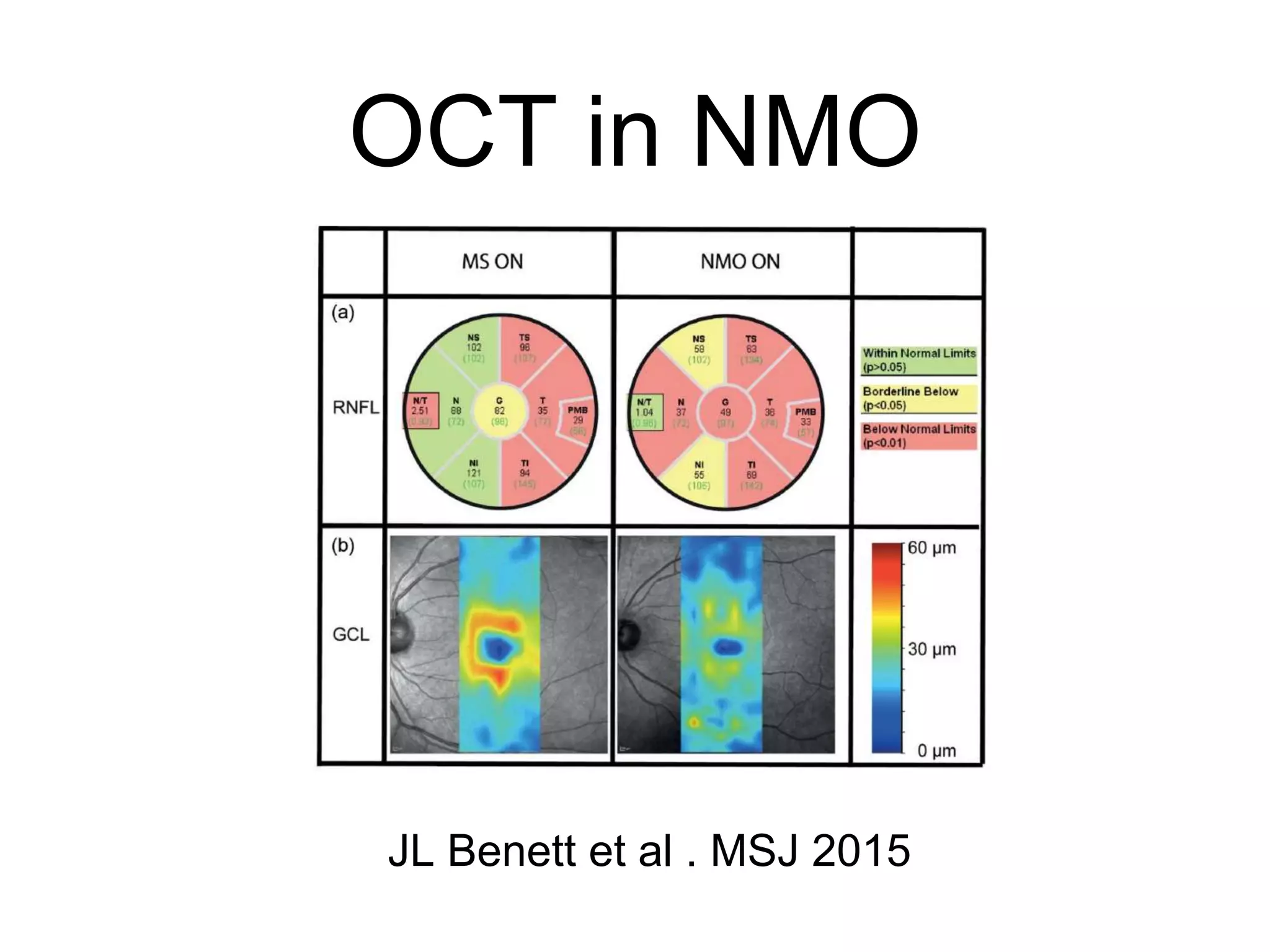 Update on Optic Neuritis and the role of OCT In Multiple Sclerosis | PPTX