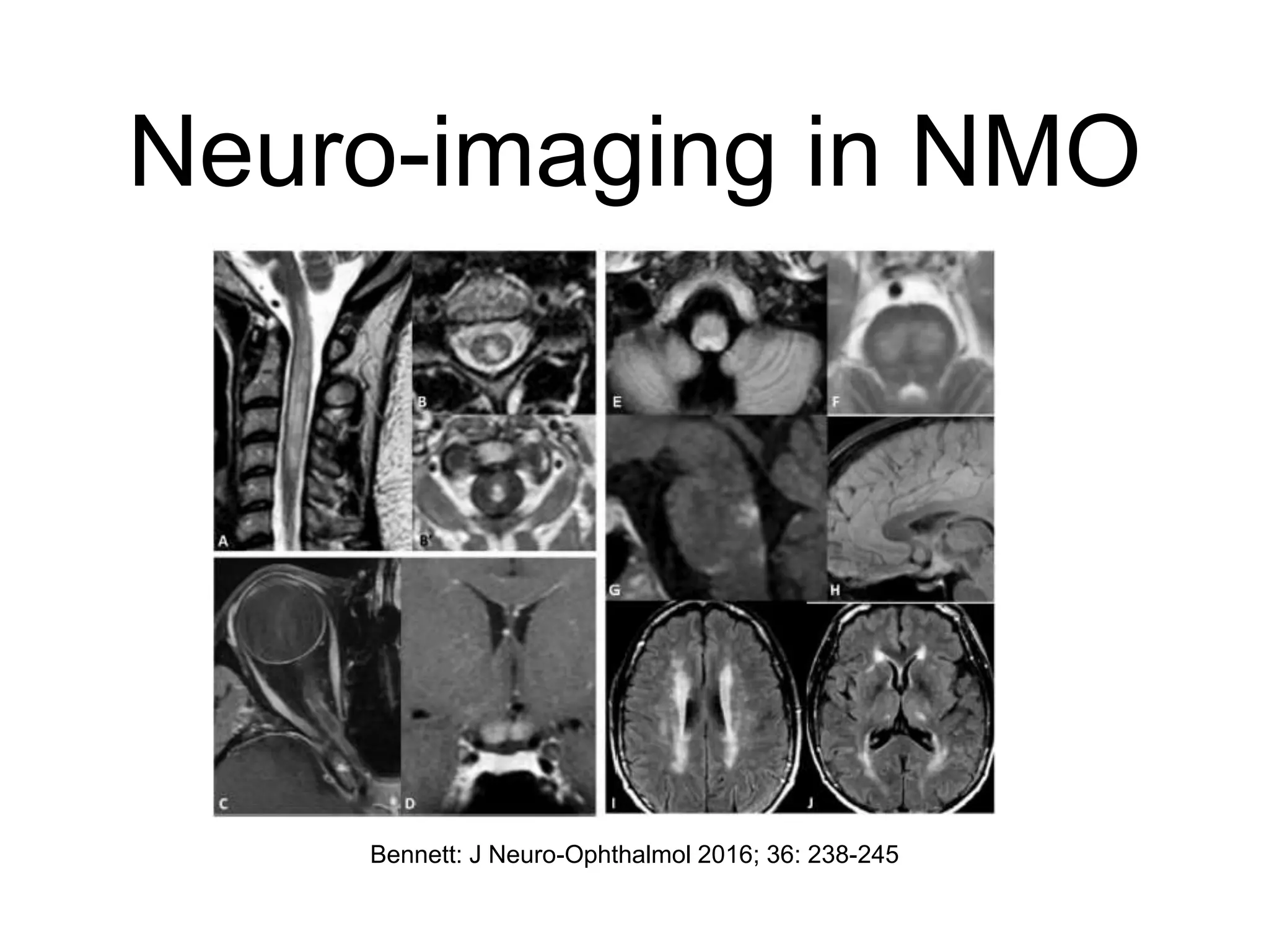 Update on Optic Neuritis and the role of OCT In Multiple Sclerosis | PPTX