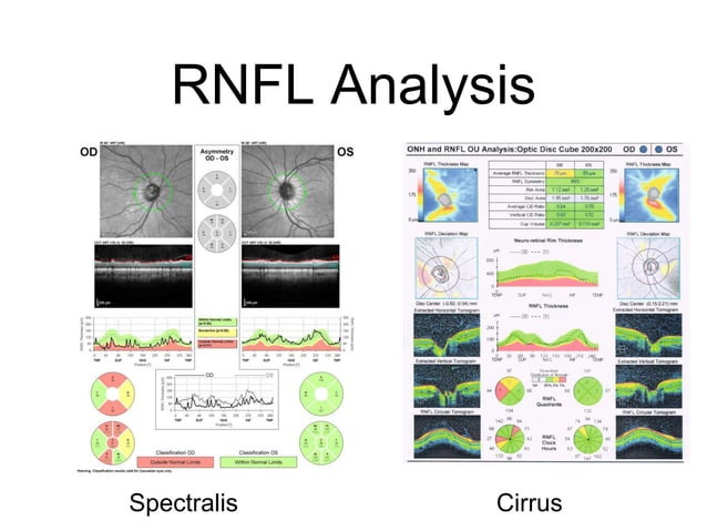 Update on Optic Neuritis and the role of OCT In Multiple Sclerosis | PPTX
