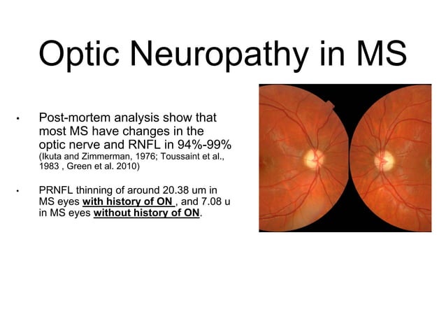 Update on Optic Neuritis and the role of OCT In Multiple Sclerosis | PPTX