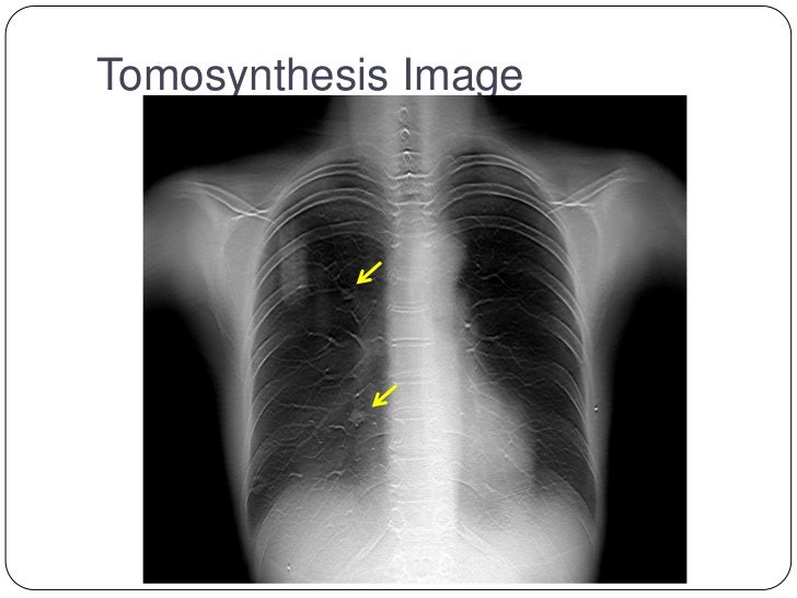 MSRT Tomosynthesis Presentation