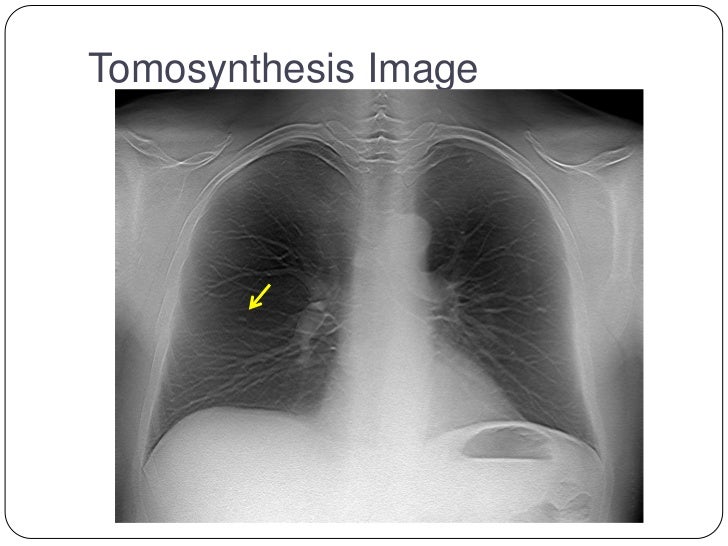 MSRT Tomosynthesis Presentation