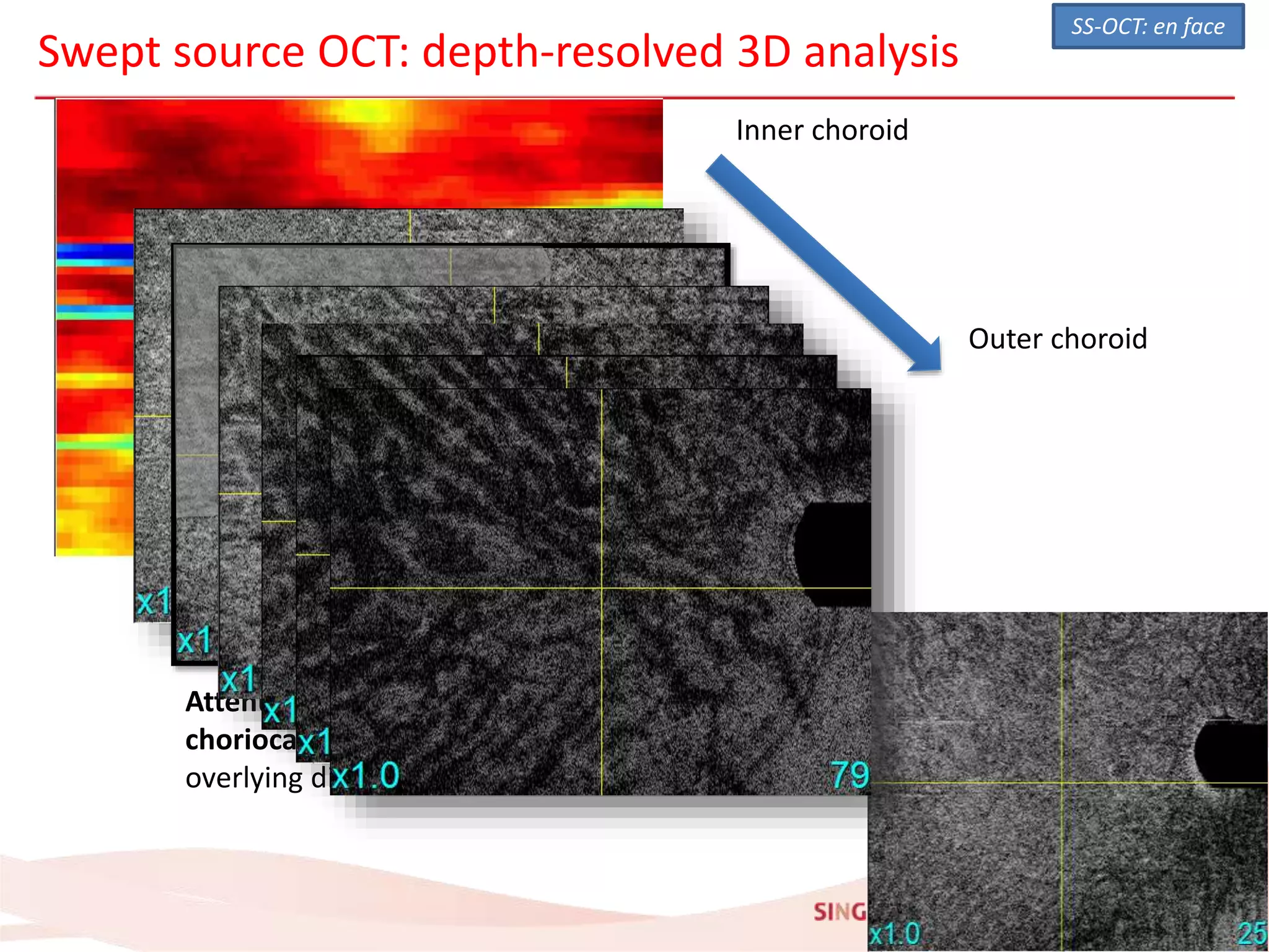 Pachychoroid spectrum diseases | PPTX