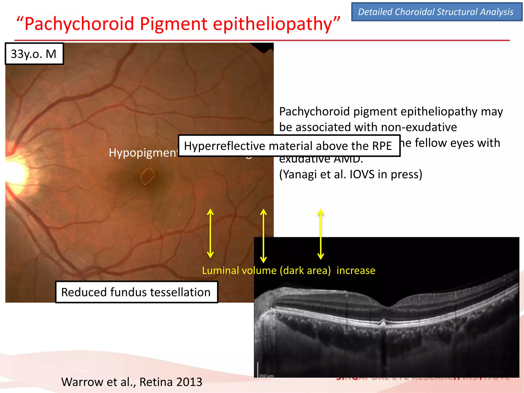 Pachychoroid spectrum diseases | PPTX
