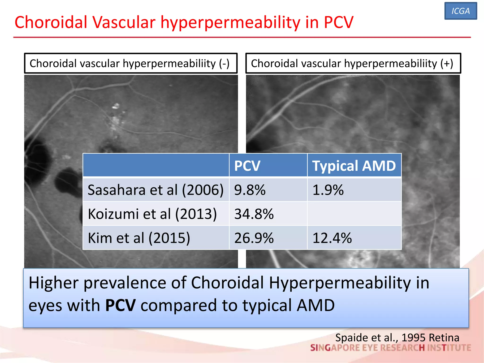 Pachychoroid spectrum diseases | PPTX