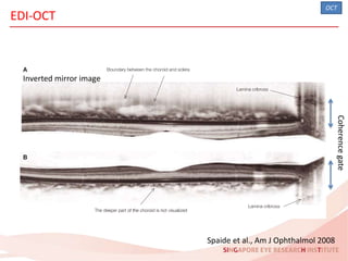 Pachychoroid spectrum diseases | PPTX