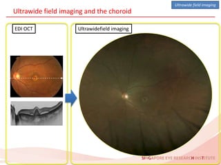 Pachychoroid spectrum diseases | PPTX