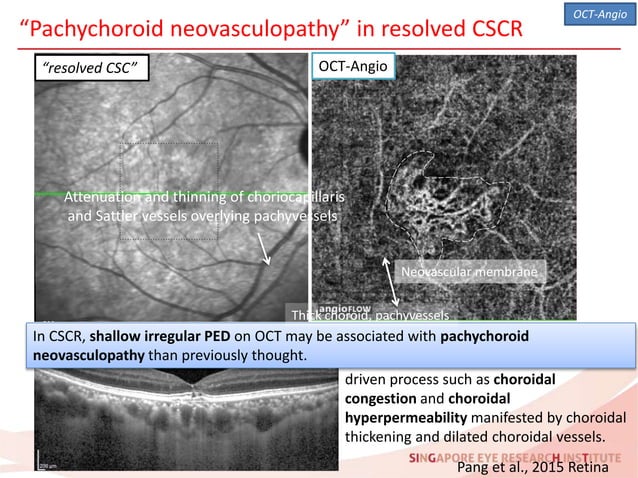 Pachychoroid spectrum diseases | PPTX