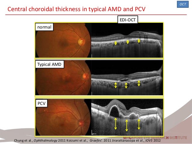 Pachychoroid spectrum diseases