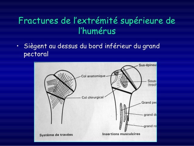 Msup fractures