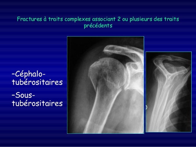 Msup fractures