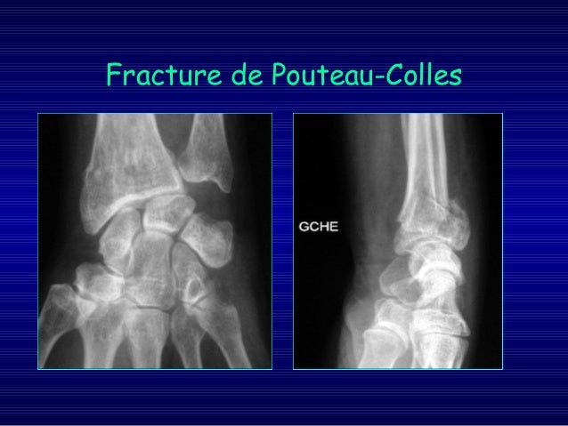 Msup fractures