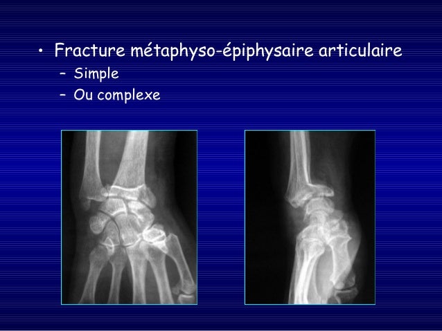 Msup fractures