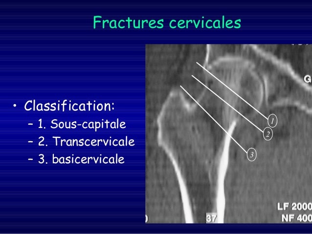 Msup fractures