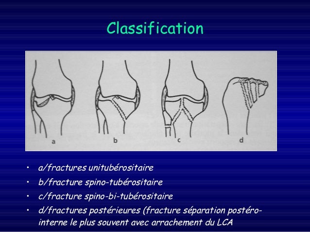 Msup fractures