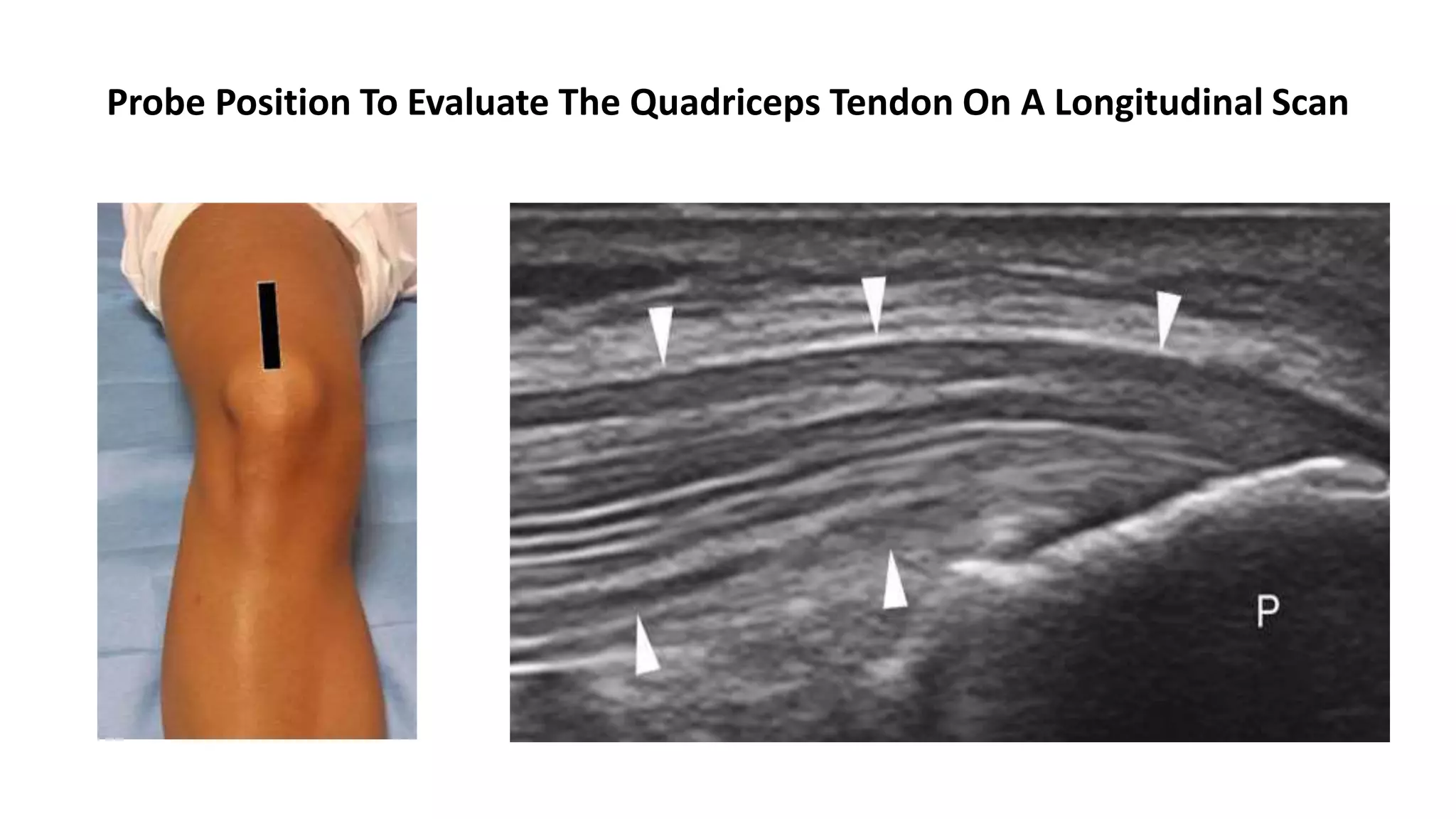 Muscloskeletal Ultrasound of the knee (basic level) | PPTX