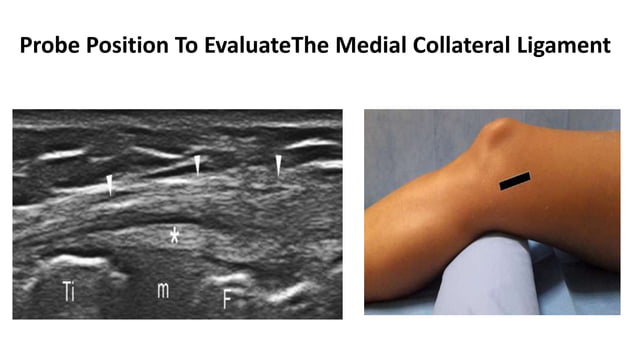 Muscloskeletal Ultrasound of the knee (basic level) | PPTX