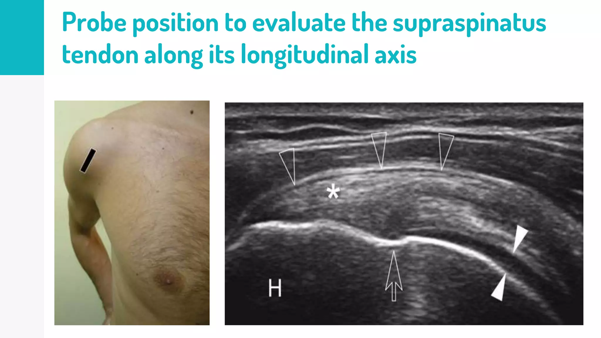 Muscloskeletal Ultrasound of the shoulder (basic level) | PPTX