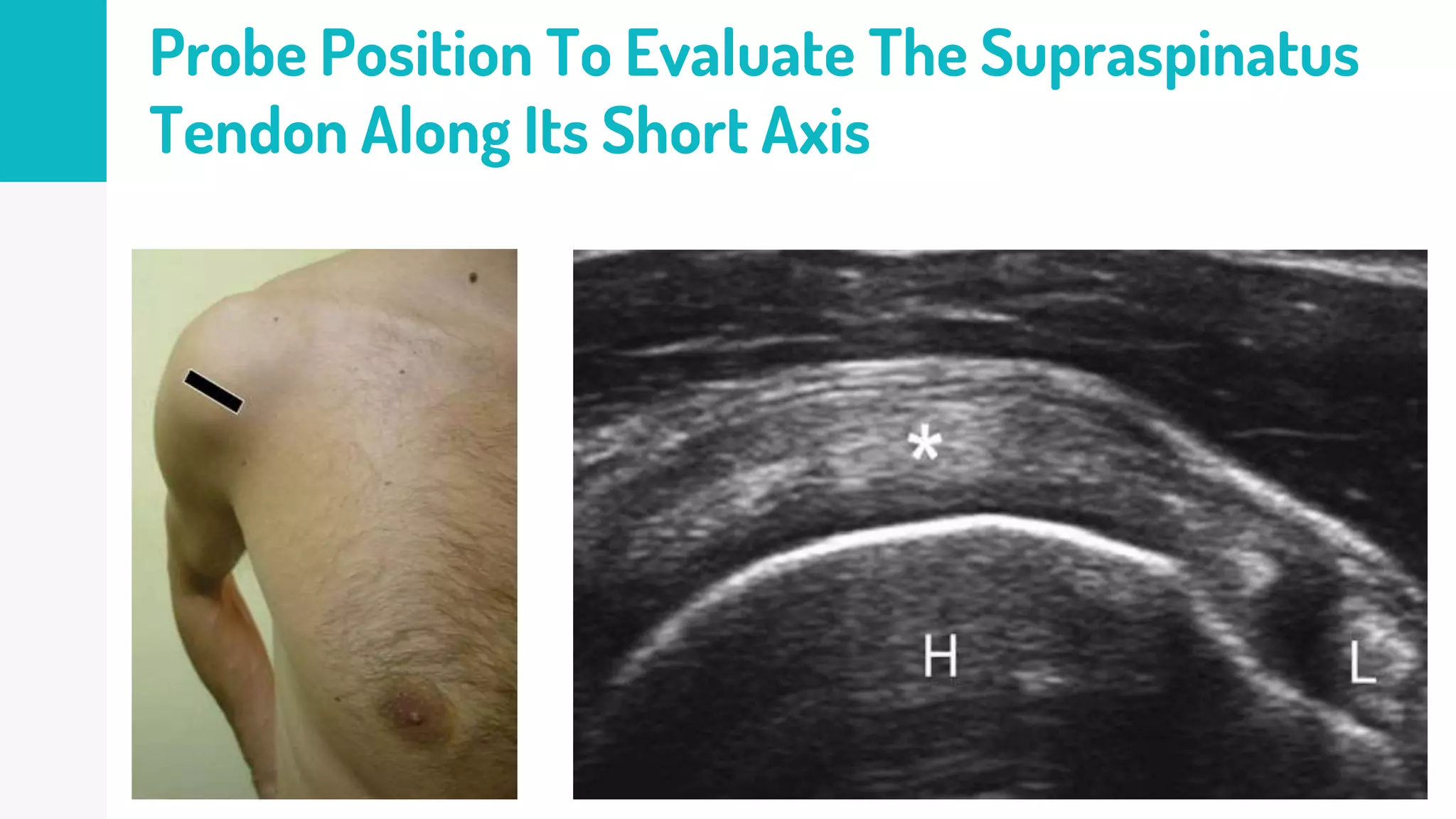 Muscloskeletal Ultrasound of the shoulder (basic level) | PPTX
