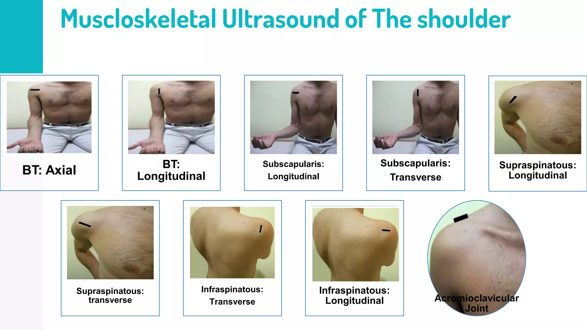 Muscloskeletal Ultrasound of the shoulder (basic level) | PPTX