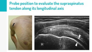 Muscloskeletal Ultrasound of the shoulder (basic level) | PPTX