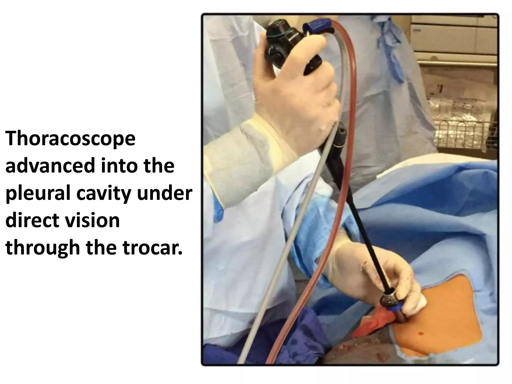 medical thoracoscopy2022 | PPTX