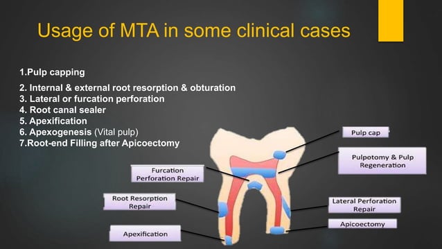MTA ( Mineral Trioxide Aggregate ) | PPTX