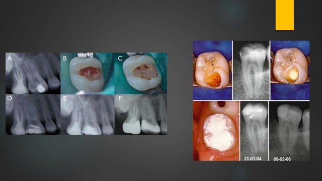 MTA ( Mineral Trioxide Aggregate ) | PPTX