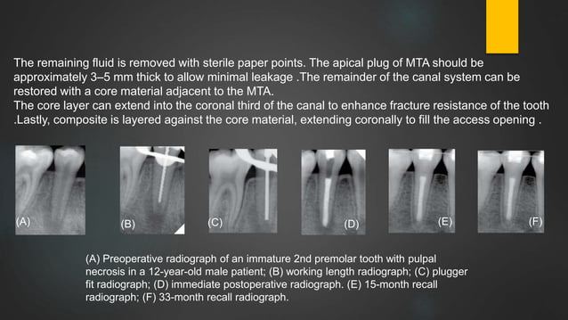 MTA ( Mineral Trioxide Aggregate ) | PPTX