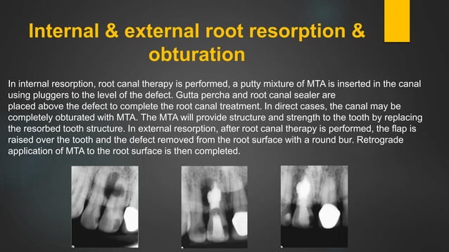 MTA ( Mineral Trioxide Aggregate ) | PPTX