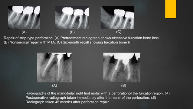 MTA ( Mineral Trioxide Aggregate ) | PPTX