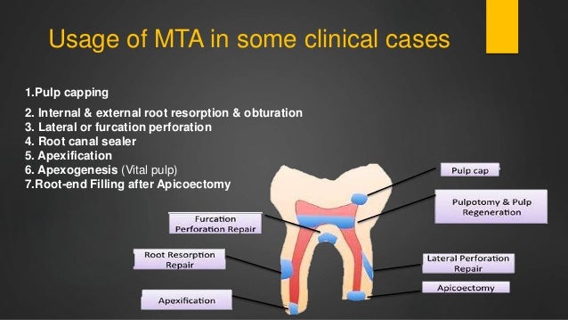 MTA ( Mineral Trioxide Aggregate )