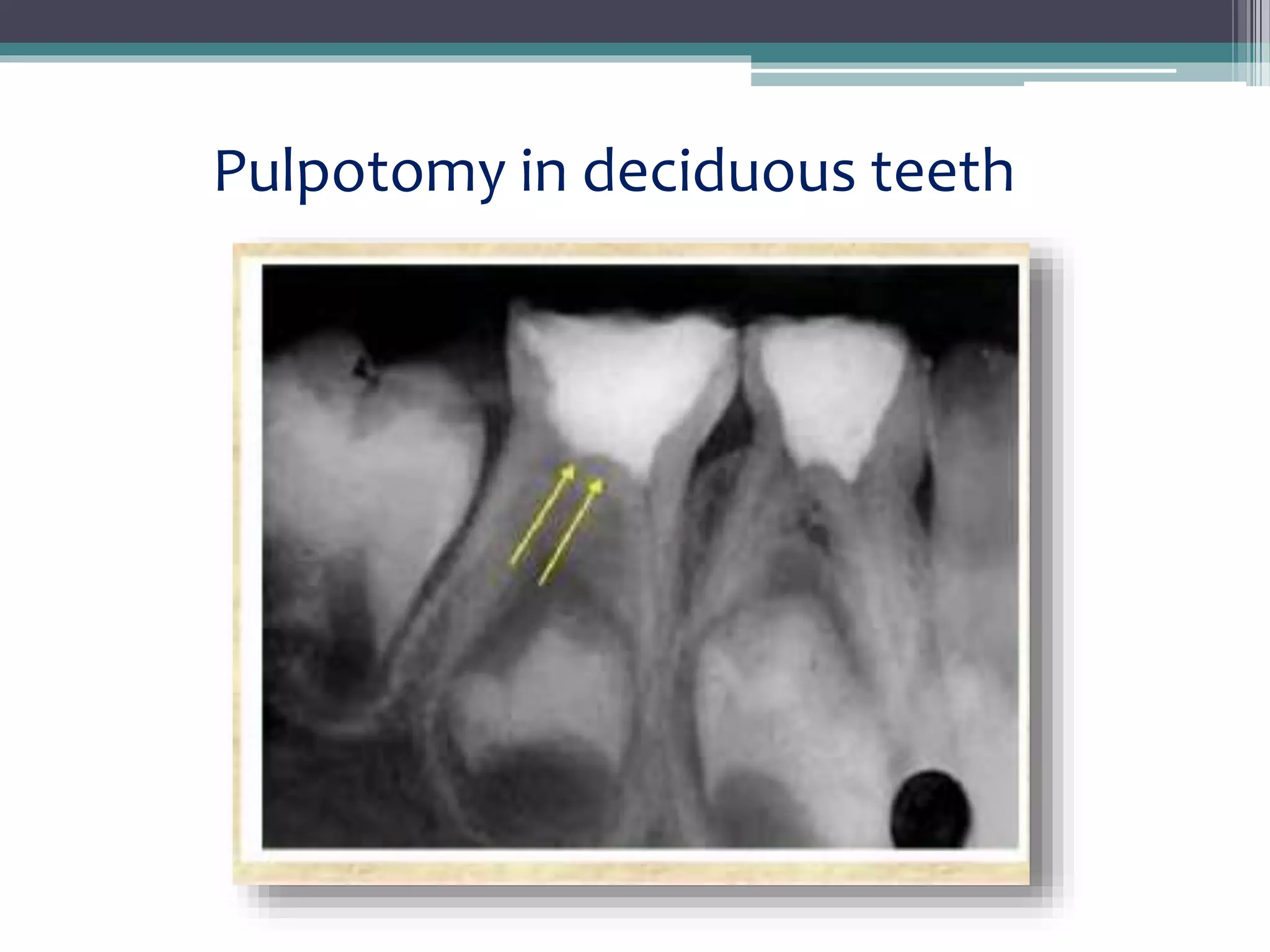 MTA & Biodentine | PPTX
