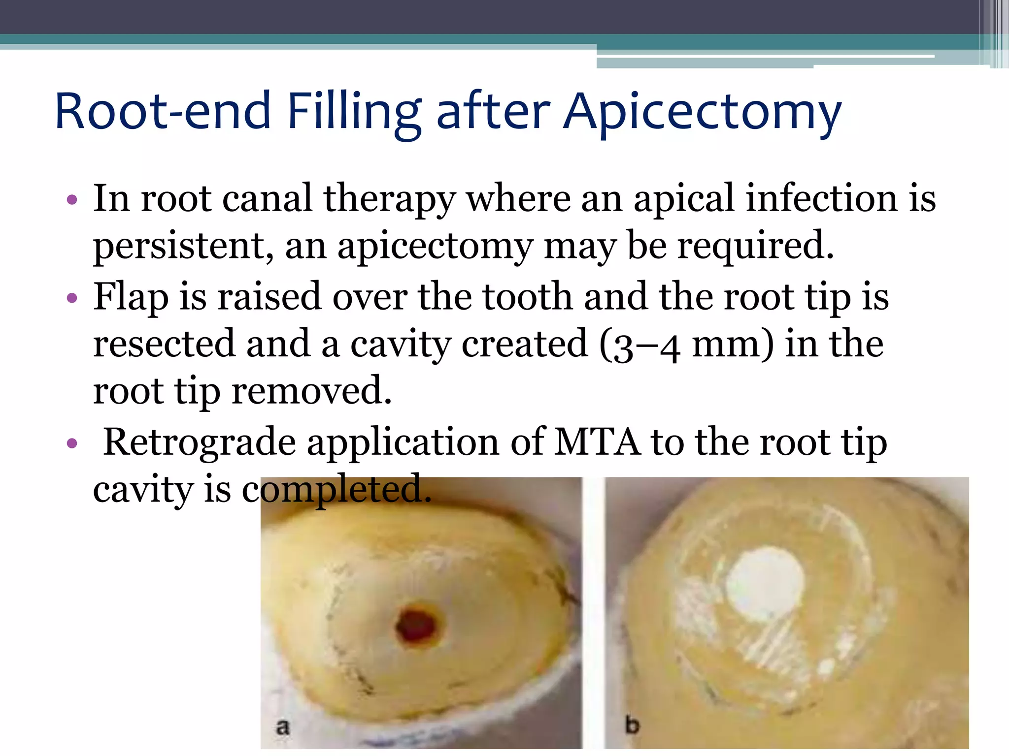 MTA & Biodentine | PPTX