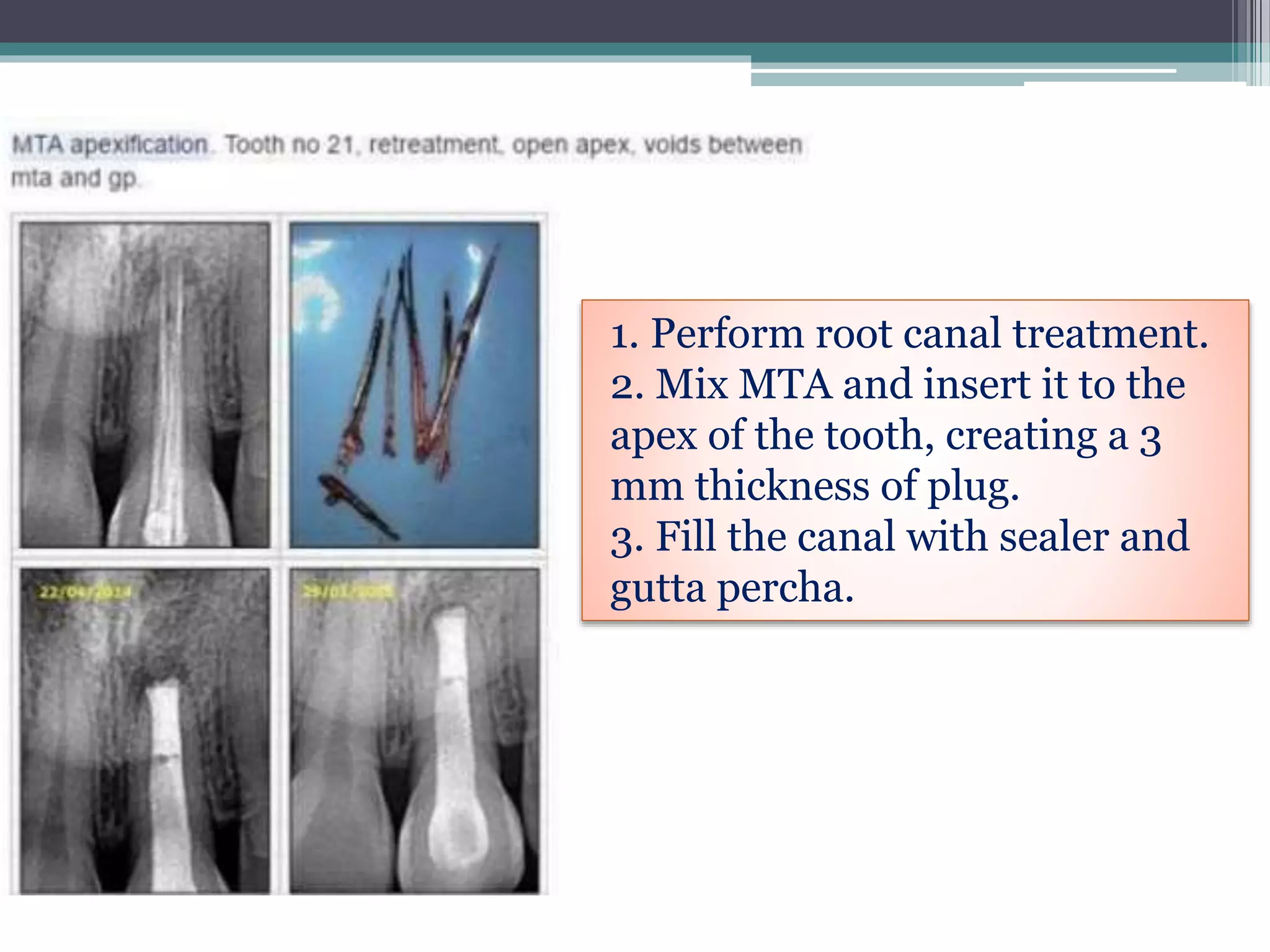 MTA & Biodentine | PPTX