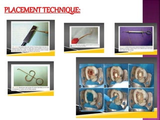 Mta, calcium hydroxide , biodentin | PPTX