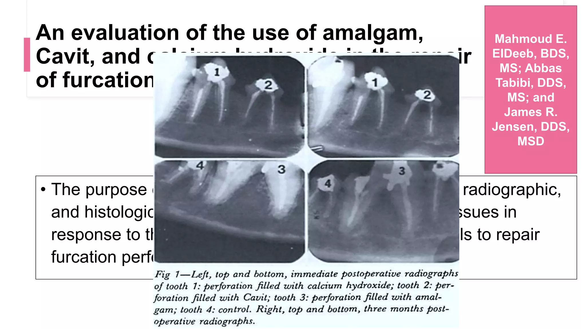 SEALING ABILITY OF MTA FOR REPAIR OF LATERAL ROOT PERFORATION | PPTX