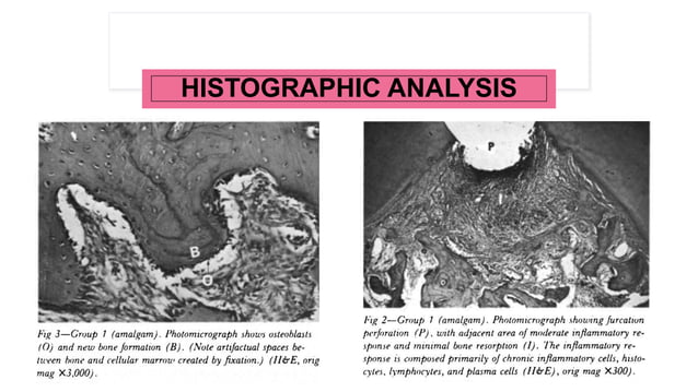 SEALING ABILITY OF MTA FOR REPAIR OF LATERAL ROOT PERFORATION | PPTX