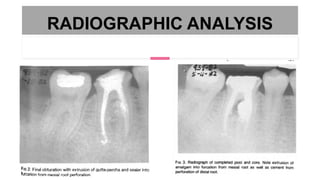 SEALING ABILITY OF MTA FOR REPAIR OF LATERAL ROOT PERFORATION | PPTX
