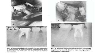 SEALING ABILITY OF MTA FOR REPAIR OF LATERAL ROOT PERFORATION | PPTX