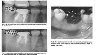 SEALING ABILITY OF MTA FOR REPAIR OF LATERAL ROOT PERFORATION | PPTX