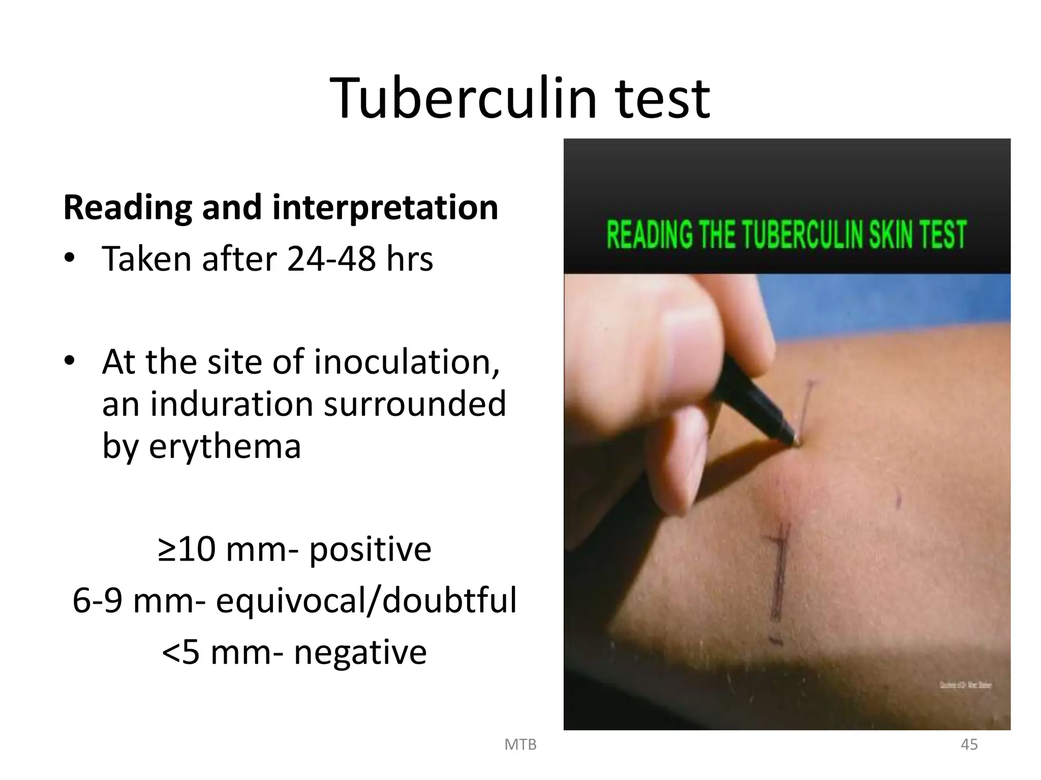 mtb classification in orthodontics and dentofacial orthopaedics | PPTX